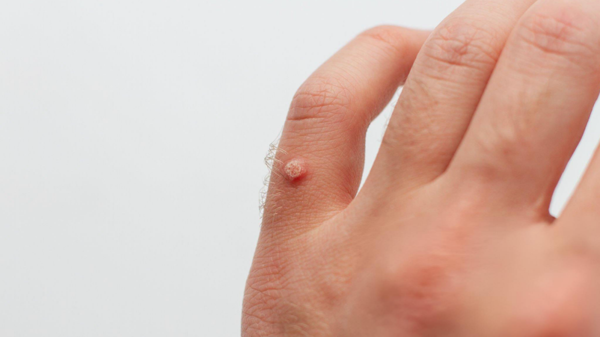 How to Identify Warts on Skin and Remove Them - Readability