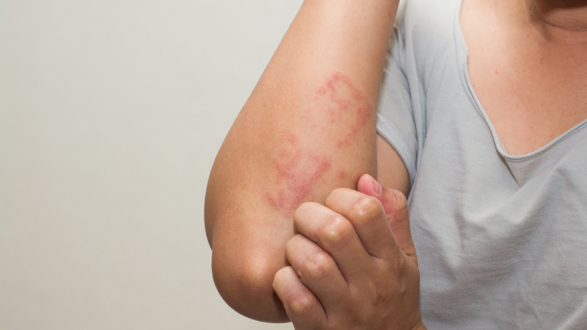 Your Guide to Scabies Treatment: Medications, Remedies, and Prevention ...