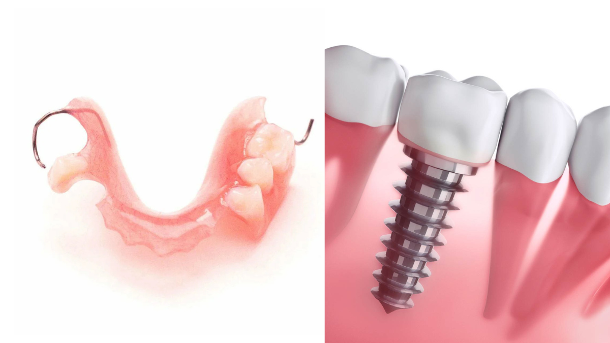 Flipper teeth vs. dental implants: key differences - Readability
