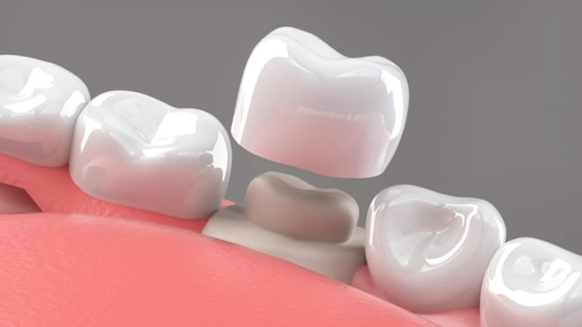 Teeth Cap Cost in India – Getting the Ultimate Deal for Lasting Smiles ...