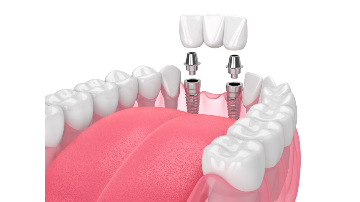 Master Implant Placement and Restoration in One Comprehensive Course ...
